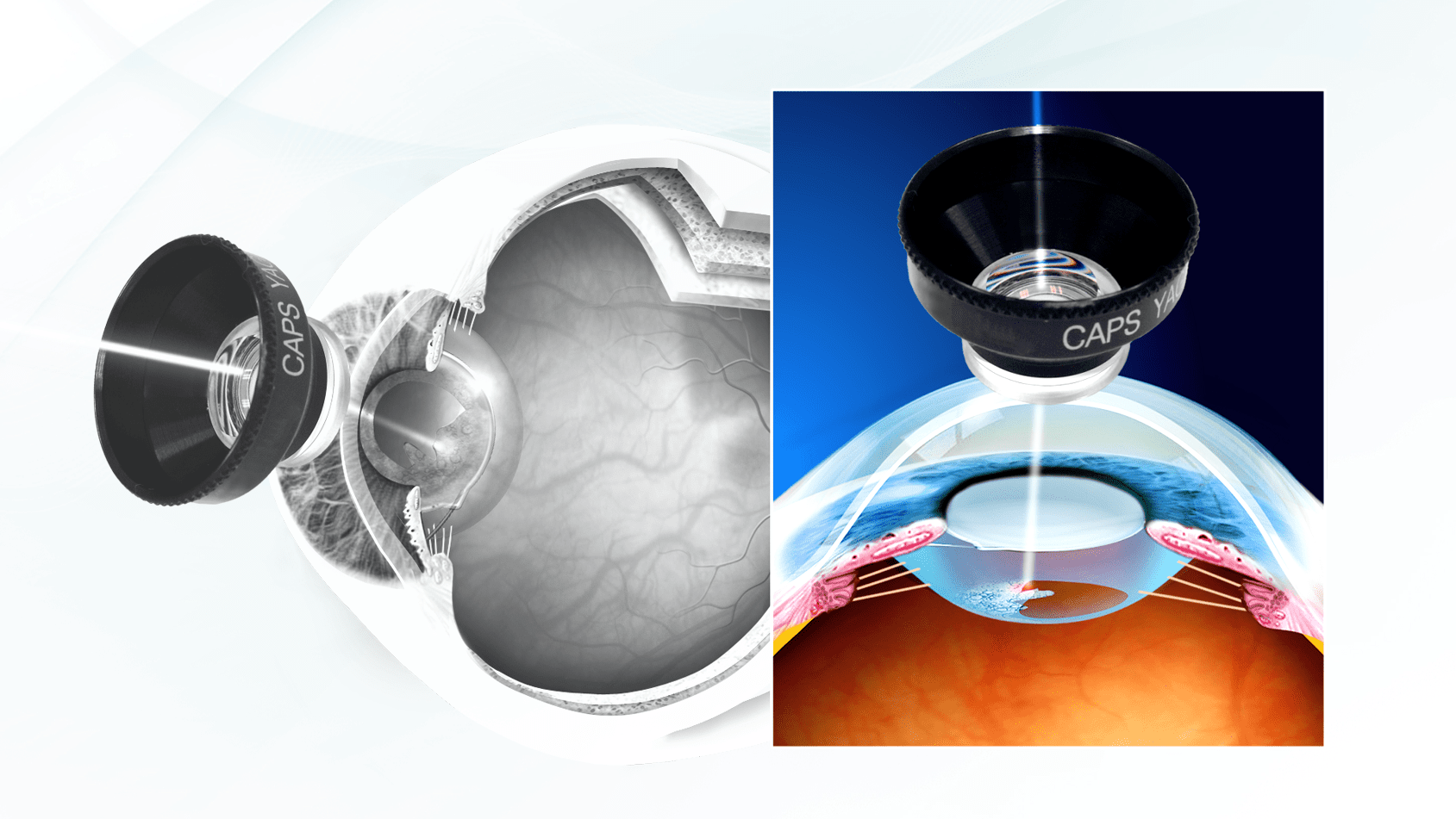 Cataratta secondaria - Sintomi - Diagnosi - Trattamento