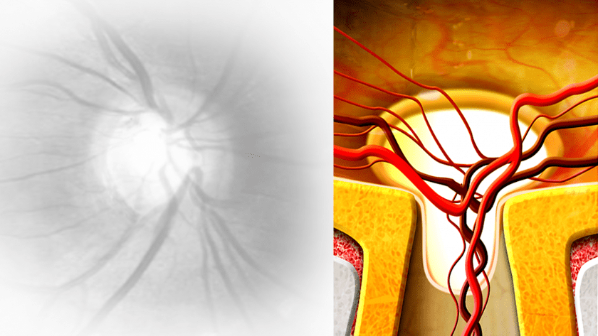 Open-angle glaucoma - Symptoms - Diagnosis - Video Open-angle glaucoma - Symptoms - Diagnosis - Video