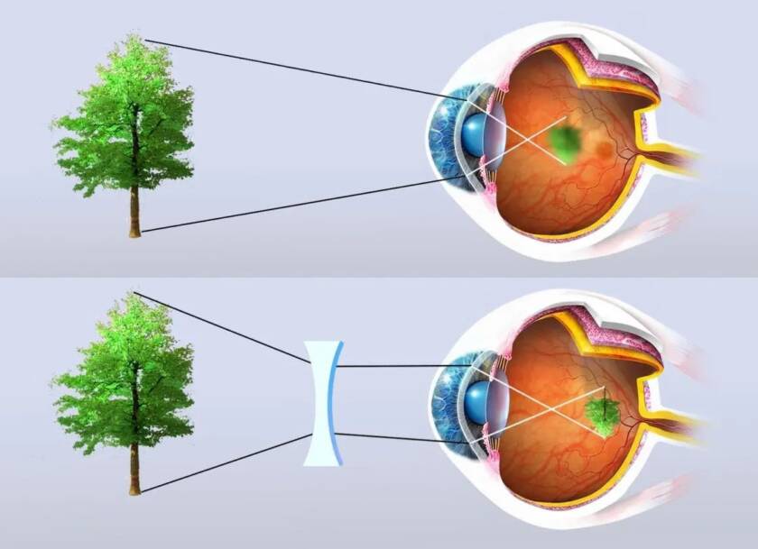 Miopia - Andrea Cusumano