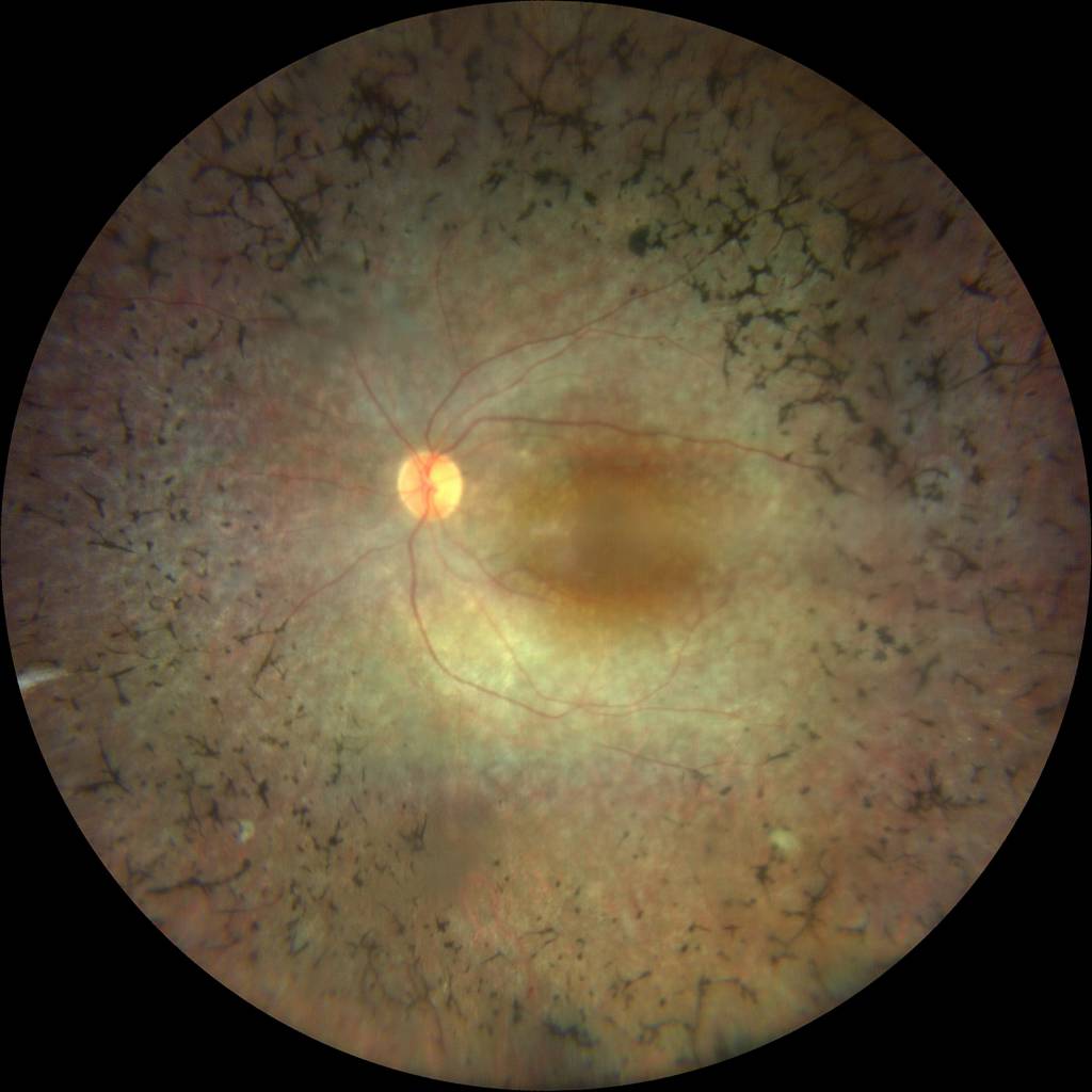 Retinite Pigmentosa - Andrea Cusumano