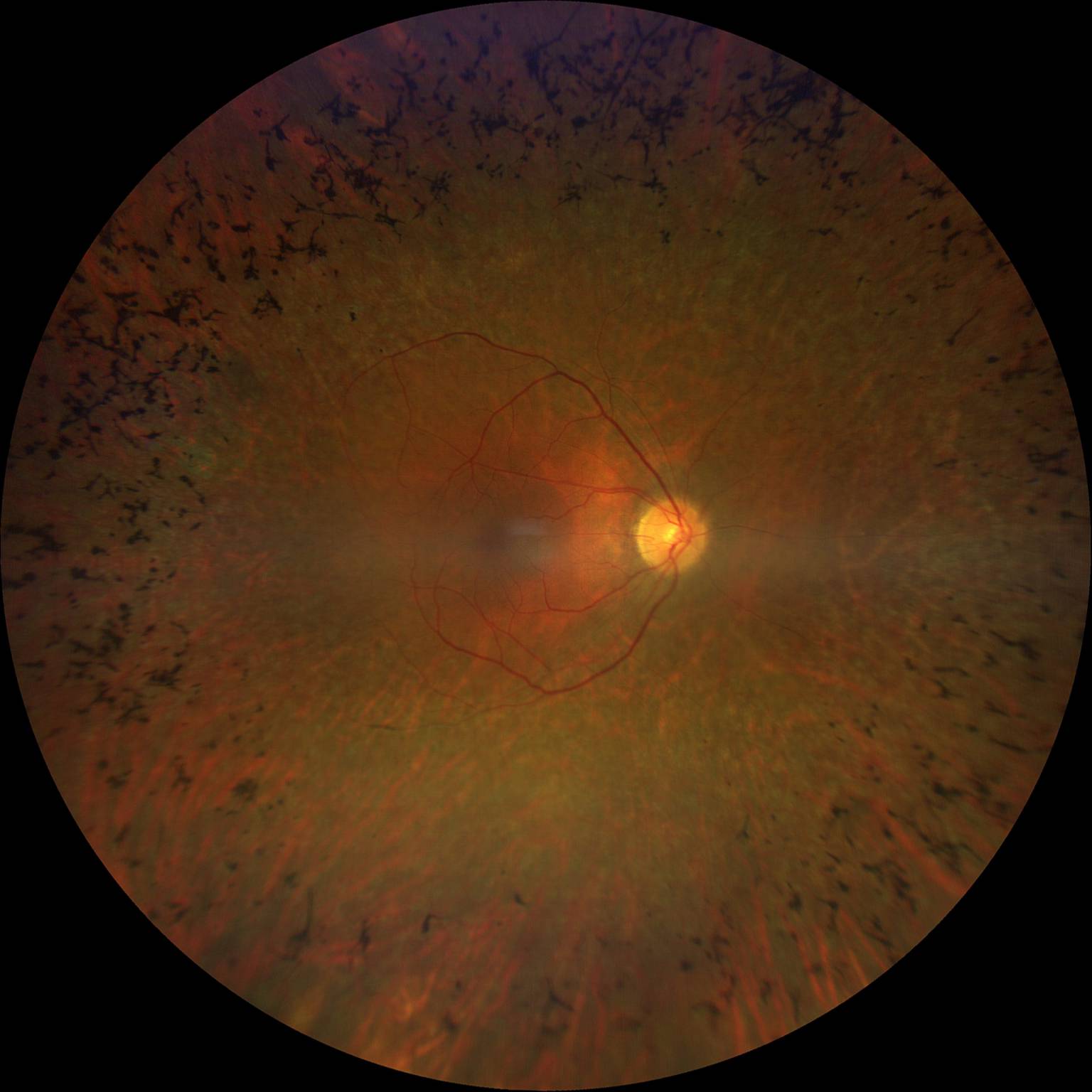 Retinosis Pigmentaria - Andrea Cusumano