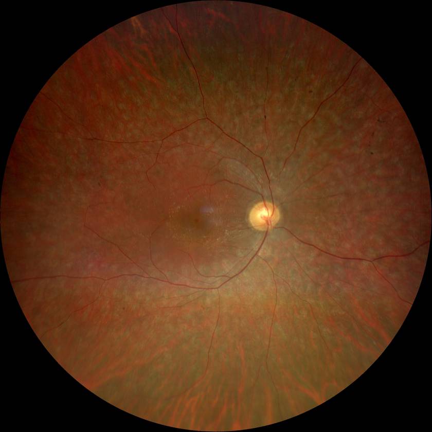 Retinitis Pigmentosa - Andrea Cusumano