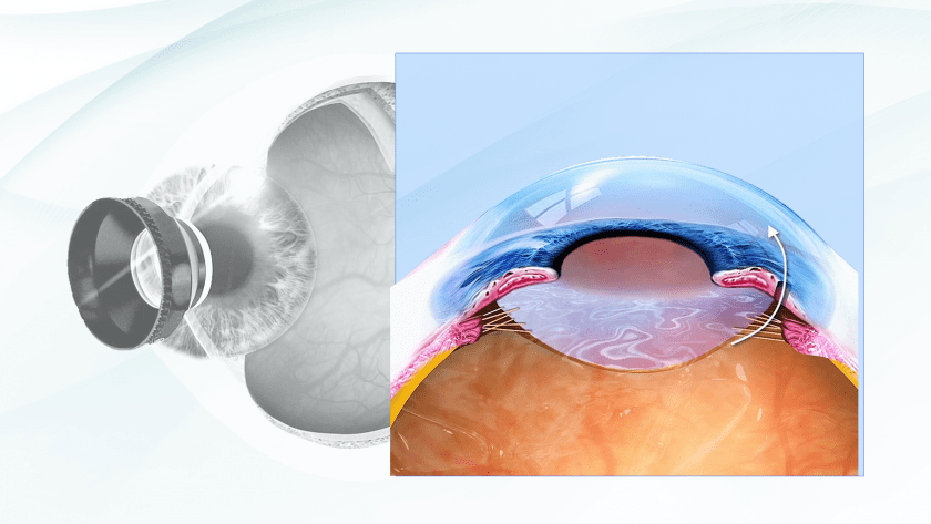 Glaucoma De ángulo Cerrado Andrea Cusumano
