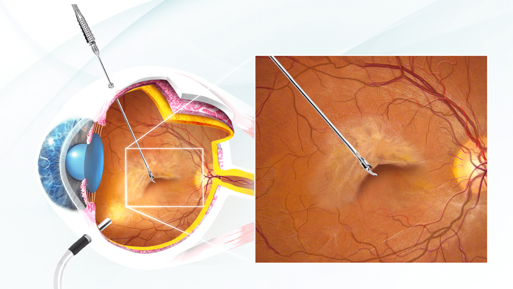 Pucker Maculare - Diagnosi - Trattamento - Video