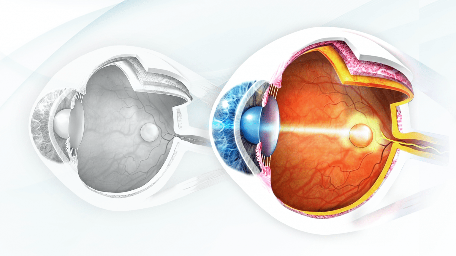 Choriorétinopathie séreuse centrale - Symptômes - Diagnostic