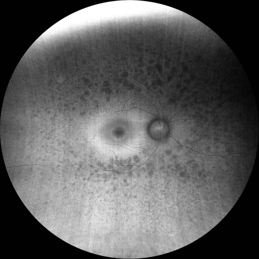 Retinitis Pigmentosa - Andrea Cusumano