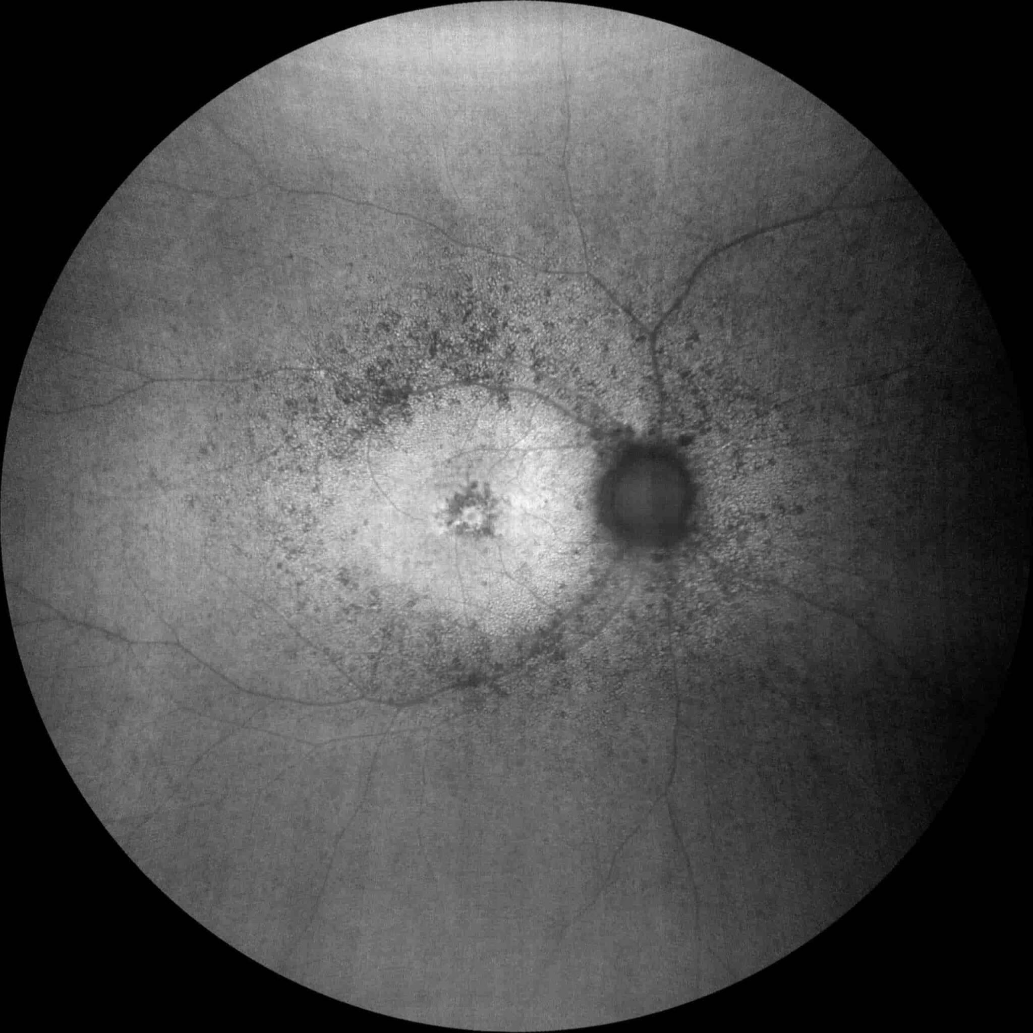 Retinitis Pigmentosa - Andrea Cusumano